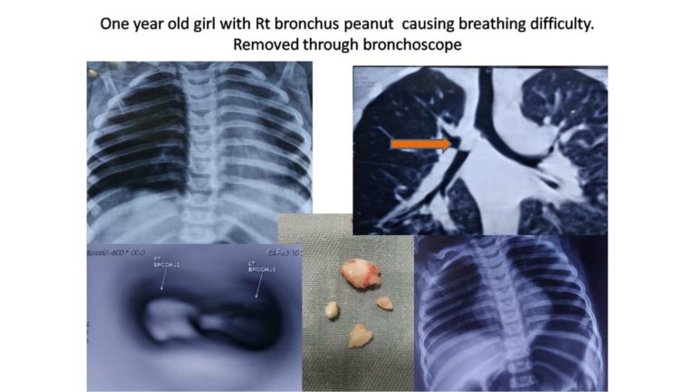 Airway obstruction due to foreign body | Dr. Devendra Taide